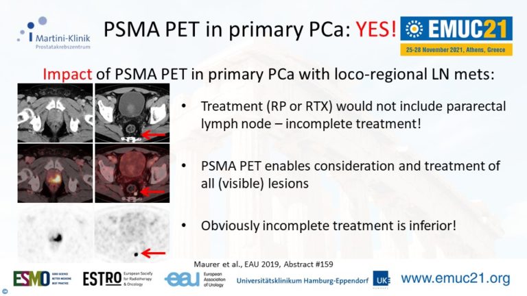 Strengths and limitations of PSMA PET: When to use it (and when not to ...